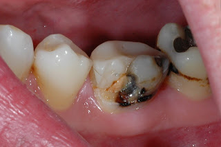 Aussiebalam: RECURRENT CARIES